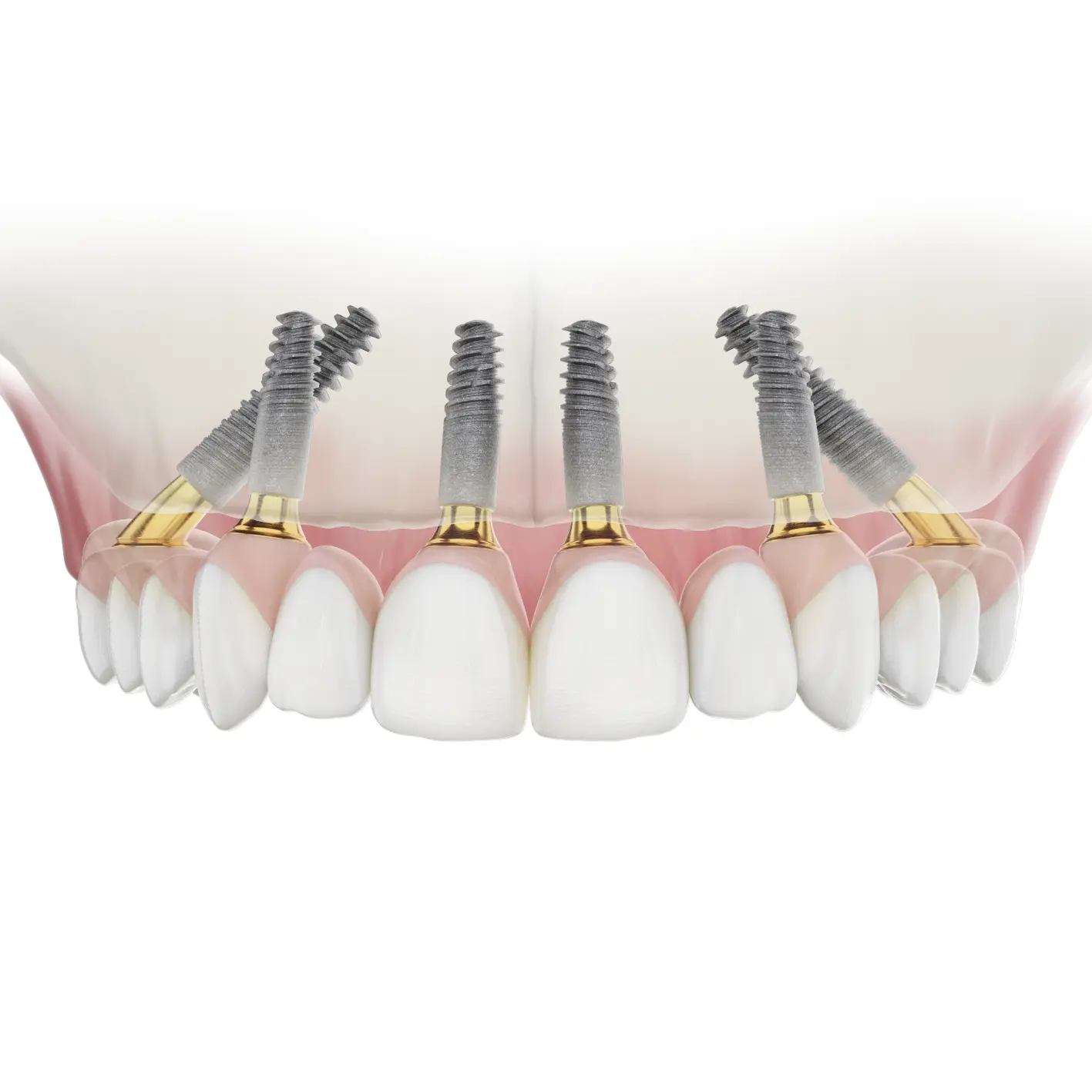 All on ROOTT Solution | Roott implants (UAE)